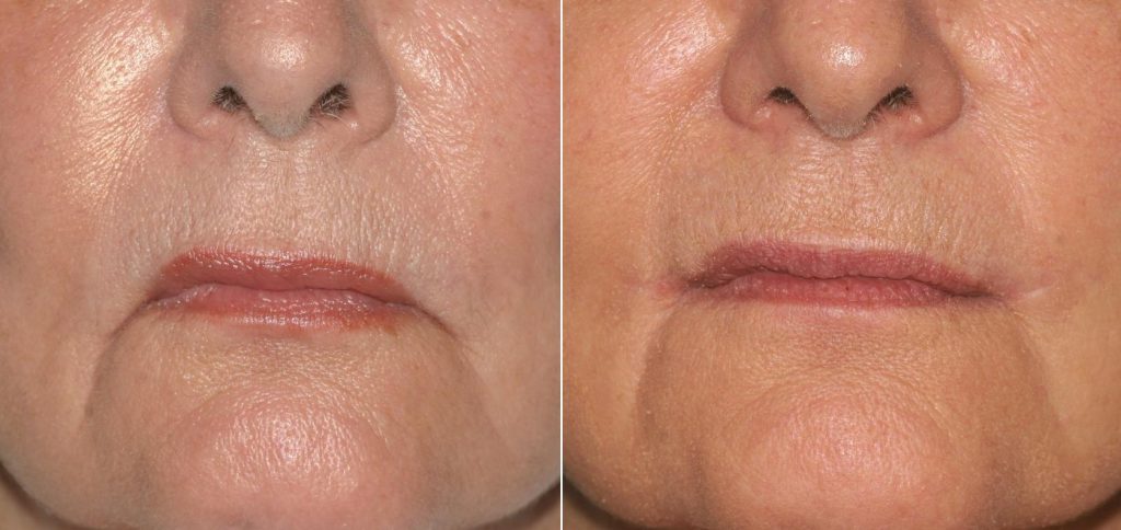 Using Wrinkle reduction treatment for Lip Enhancement (Lip Lift ...
